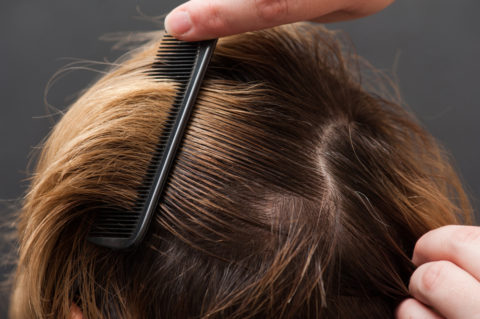 Excess Sebum on Scalp: Causes, Effects, and How to Control It - Bright ...